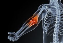 Bakerzyste - Ursachen, Symptome, Diagnose und Behandlung