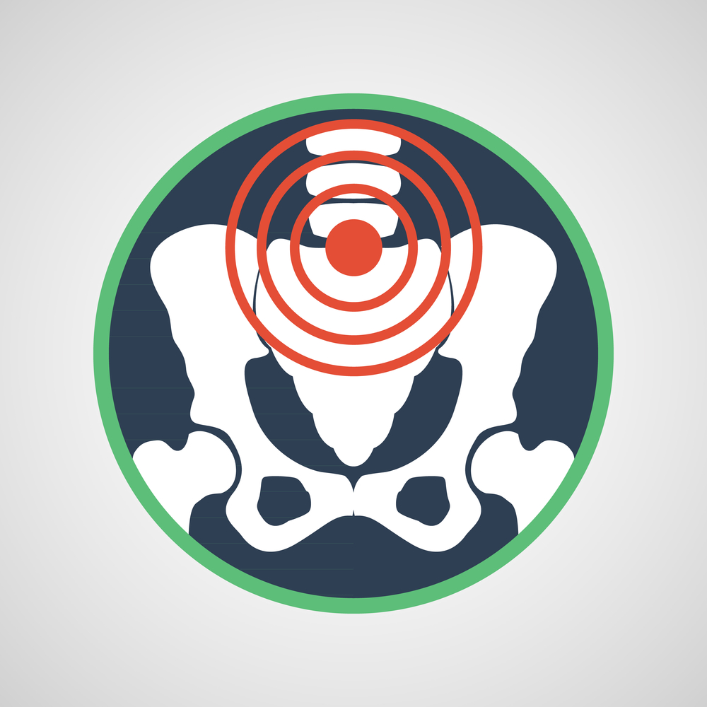 Beckenschiefstand - Ursachen, Symptome, Übungen und Behandlung