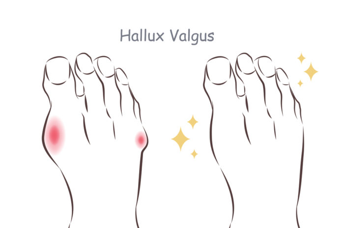 Hallux Valgus Schienen Test 2024 - Jetzt vergleichen und Testsieger kaufen
